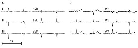Intraventricular Conduction Delay