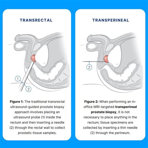 Transperineal Prostate Biopsy Vs Transrectal Benefits