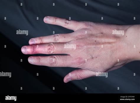 Mallet Finger Healing After Splint Removal From Middle Finger Following