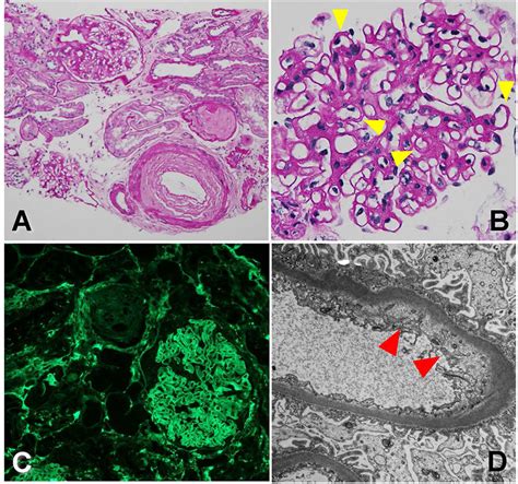 Biopsy Findings Showing Arteriopathy And Chronic Thrombotic Download Scientific Diagram