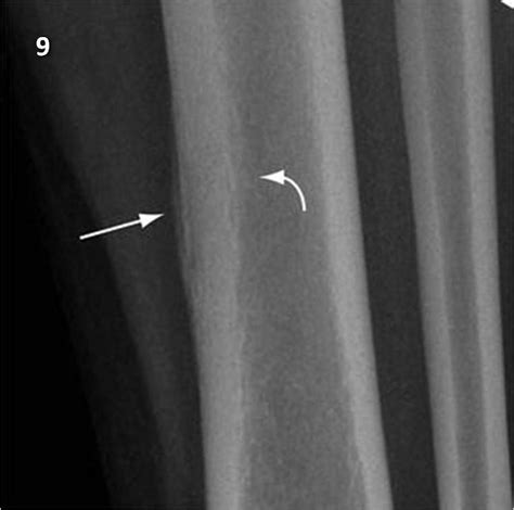 Fratura Por Estresse Na Tíbia