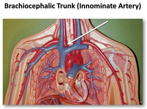 Brachiocephalic Artery