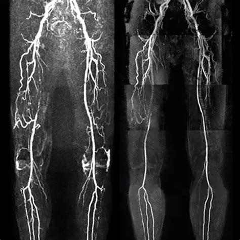Mri Scan For Mr Venography Left Lower Limb With Contrast Medifyhome