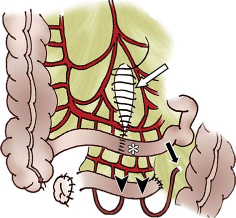 Ileal Conduit