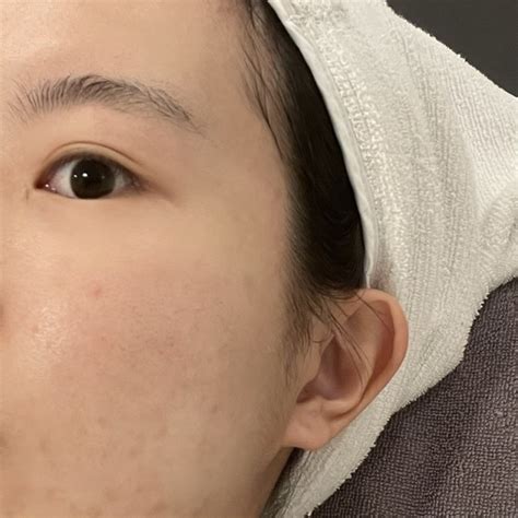 삼성역피부과 엑셀브이레이저 만족한 전후비교 후기 네이버 블로그