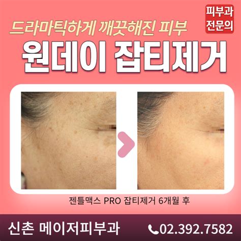신촌 피부과 잡티제거 주근깨레이저 기미레이저토닝 검버섯레이저 주근깨제거 기미 검버섯제거 점빼기 흑자제거 가격 효과 비용 이벤트 메이저피부과 홍대 이대 공덕 마포 아현 피부과