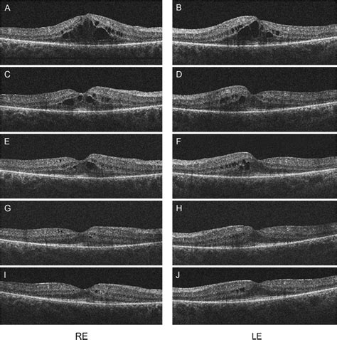 OCT Scans Of The Macula Of Both Eyes After Series Of TAC Treatment Download Scientific
