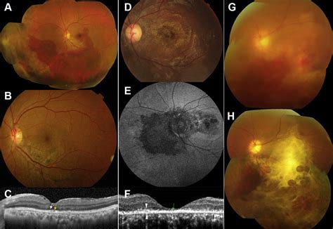 Traumatic Maculopathy With Massive Subretinal Hemorrhage After Closed