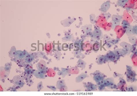 View Microscopic Trichomonas Spp Infection Pap写真素材519161989 Shutterstock