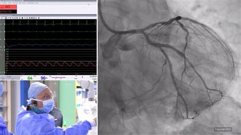 Non Left Main Bifurcation Live Case