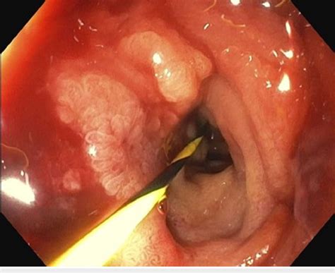 Duodenal Bulb Stenosis Secondary To Extrinsic Compression Requiring Download Scientific