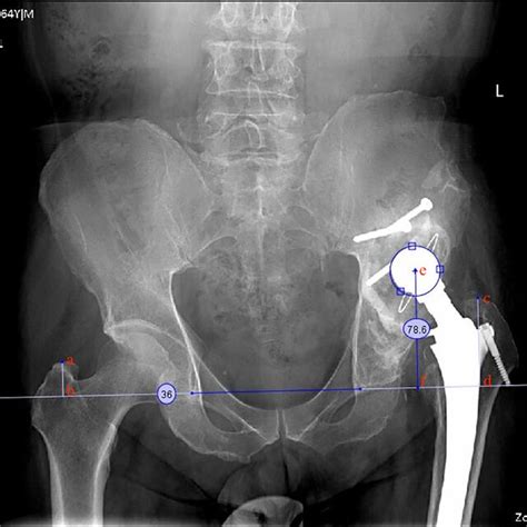 The Limb‐length Discrepancy Lld And Vertical Hip Center Of Rotation Download Scientific