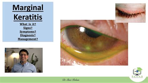 Can Keratitis Be Treated At Lois Toussaint Blog