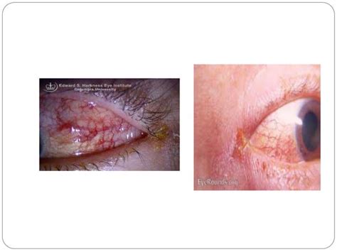 Angular Conjunctivitis Pptx Eye And Vision Conditions Diseases