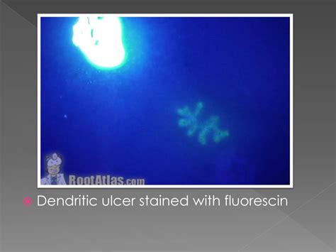 Ppt Herpes Simplex Dendritic Ulcer Powerpoint Presentation Free