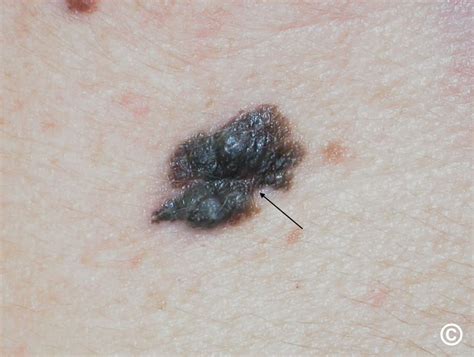 Melanoma