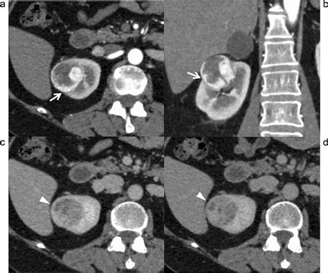 Contrast Enhanced Computed Tomography Of A Clear Cell Renal Cell