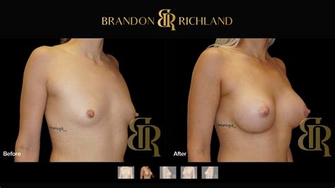 Breast Augmentation Before And After Transformations To Inspire Dr
