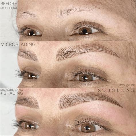 Alopecia Areata Eyebrows