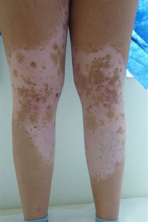 Piebaldism Dermatology Advisor