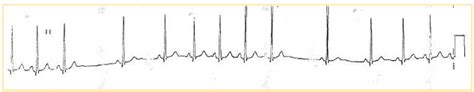 Topic Sinoatrial Node Exit Block Av Blocks Arrhythmia Interpretation Certification Course