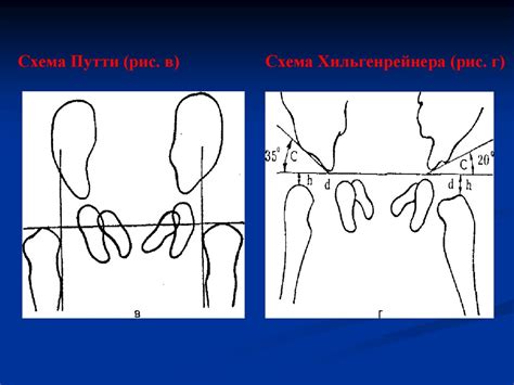 Врождённый вывих бедра презентация онлайн