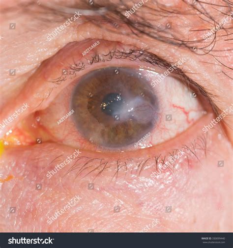 Interstitial Keratitis Diagnosis And Treatment Hhct