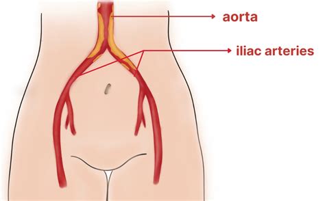 Aortoiliac Occlusive Disease Bevsa Buffalo Endovascular And Vascular