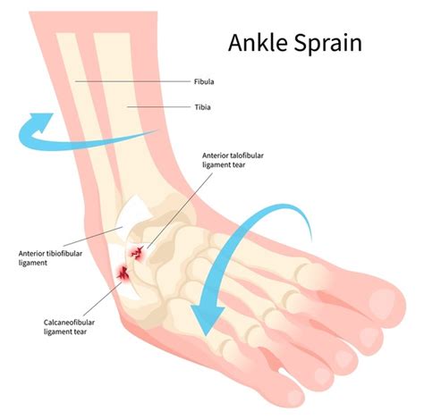 Ankle Dislocation Diagram