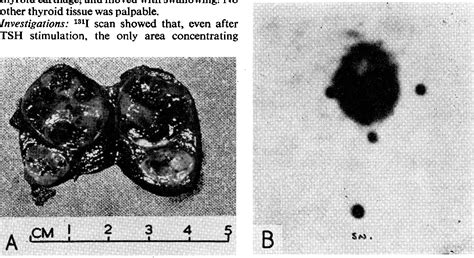Figure 1 From An Ectopic Thyroid Semantic Scholar