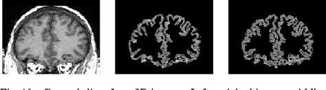 Figure 10 From Segmentation And Measurement Of The Cortex From 3 D Mr