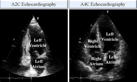 The Chambers Of The Heart In A2c And A4c View Echocardiography