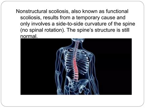 Structural Vs Nonstructural Scoliosis Cordus Ppt