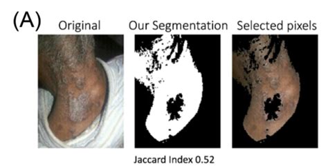 darker skin absent from medical texts laser and other treatments for