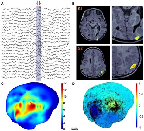 Encoding Of Epileptic Spike In Diverging Features A Meg Traces With Download Scientific