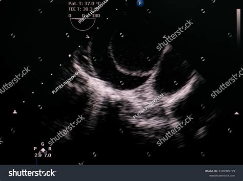 Transesophageal Echocardiogram Aorta
