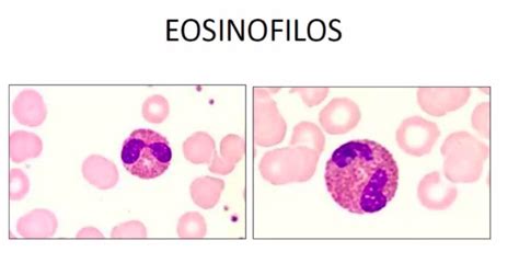 Eosinófilos Hematología