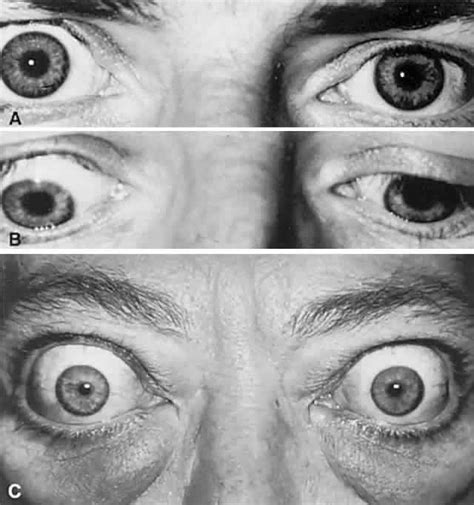 What Is Lid Lag With Pictures Thyroid Eye Disease A Southeast Asian