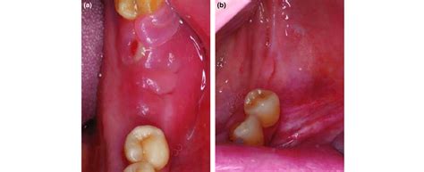 Left Lower Gingiva Showing Slight Pus Exudation In The Site Of Dental