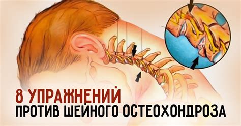 Упражнения от шейного остеохондроза