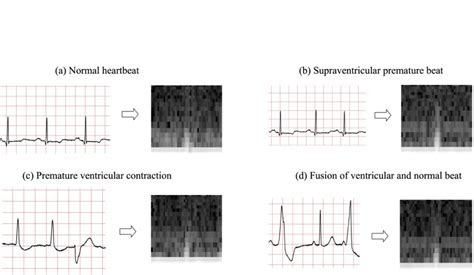 Ecg Grey Scaled Spectrograms Of The 4 Class In Mit Bih Dataset Download Scientific Diagram