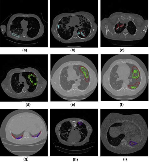 Deep Learning For Screening Of Interstitial Lung Disease Patterns In