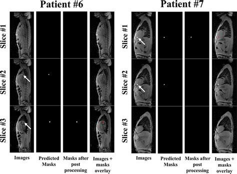 The Complete Reconstruction Pipeline Shown For Patients 6 And 7 Here Download Scientific