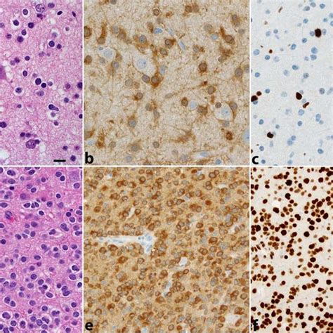 Pdf Idh Mutation 1p19q Codeletion And Atrx Loss In Who Grade Ii Gliomas