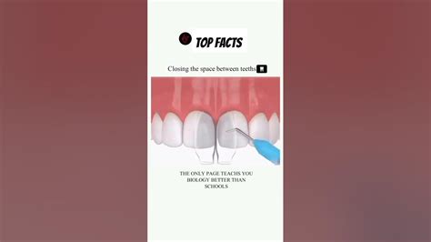 Closing Space Between Teeths Biography Biology Facts Knowledge Teeth Youtube