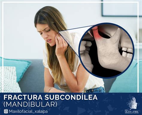 Las Fracturas Del Cóndilo Mandibular Maxilofacial Xalapa