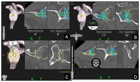 3d Ct Based Preoperative Planning And Intraoperative Navigation In Reverse Shoulder Arthroplasty