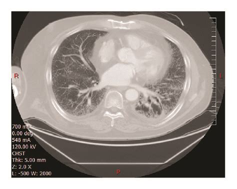 Ct Images 3 Months After The Initial Presentation Of Pneumonitis