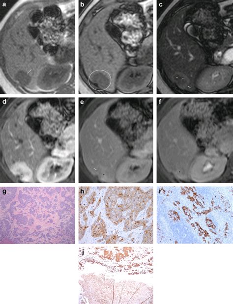 Current Update On Combined Hepatocellular Cholangiocarcinoma Pmc