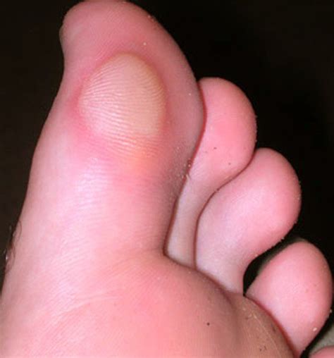 Itchy Between Toes Common Causes And Treatment Bvmem